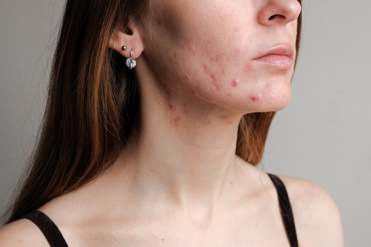 The Best Sheets For Acne or Acne-Prone Skin | Ethical Bedding™